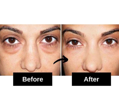 15 Most Effective Home Remedies For Puffy Eyes Fabbon