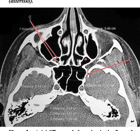 Figure 2 From The Maxillary Recess Of The Sphenoid Sinus Semantic