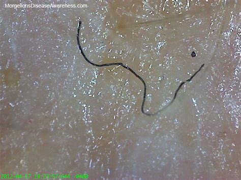 morgellons disease awareness morgellons disease physicians reference