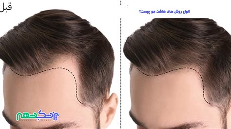 انواع روش های کاشت مو چیست؟ مزایا و معایب پزشک شهر