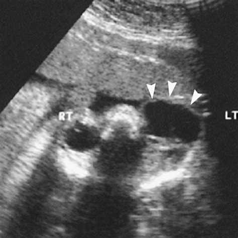 5 4 Occipital Meningocele With An Associated Dandy Walker Cyst