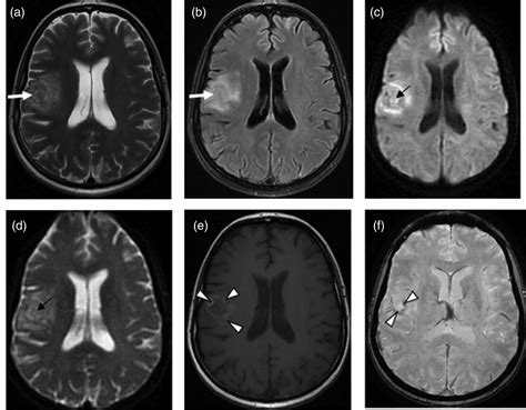 Cerebral Toxoplasmosis In Hiv Infected Patients Over 2015 2018 A Case
