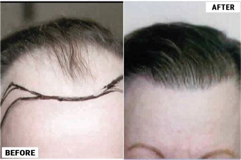 Hair Transplant Before And After Forhair Hair Transplant Results