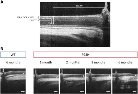 Sd Oct Retinal Thickness Layers And Retinal Morphology A Outer