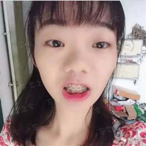 拔4颗4号牙，2颗智齿，整牙期间割了双眼皮，活成了自己想要的样子 蜜颜优惠