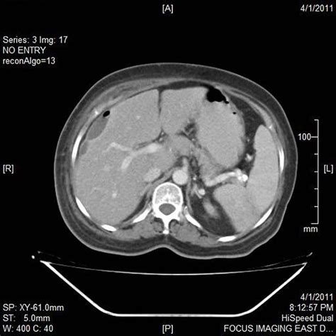 Contrast Enhanced Computerized Tomography Cect Of The Abdomen Showing