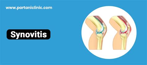 What Is Synovitis And How Does It Affect Arthritis 58 Off