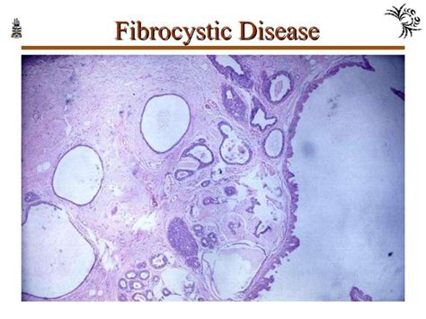 Pathology Of Breast Disorders Ppt