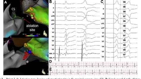 Figure 2 From Successful Ablation Of Premature Ventricular Contractions