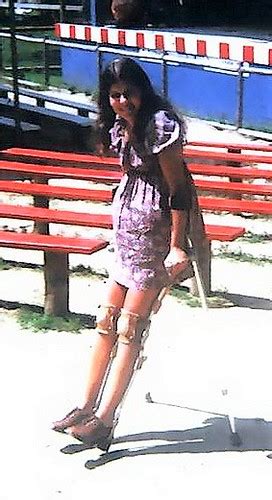 1960s Polio Miniskirt A 1960s Mini Skirted Polio Girl Flickr