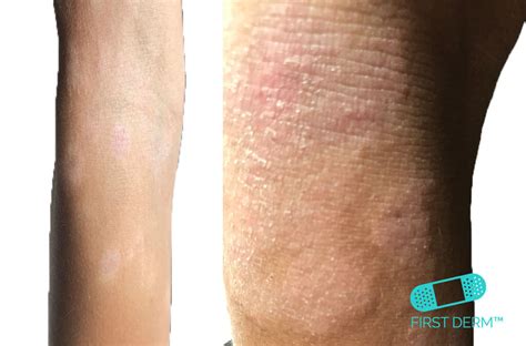 Itchy Rash On Arms