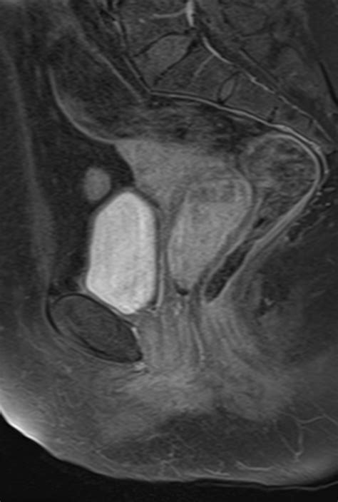Prolapsed Endometrial Polyp Image