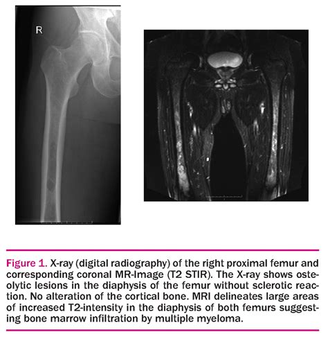 Bone Involvement In Patients With Systemic Al Amyloidosis Mimics Lytic