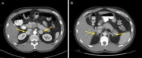 Robot Assisted Laparoscopic Partial Adrenalectomy Initial Experience