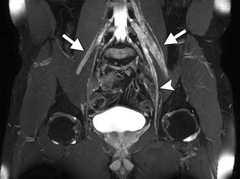 High Resolution 3 T Mr Neurography Of The Lumbosacral Plexus