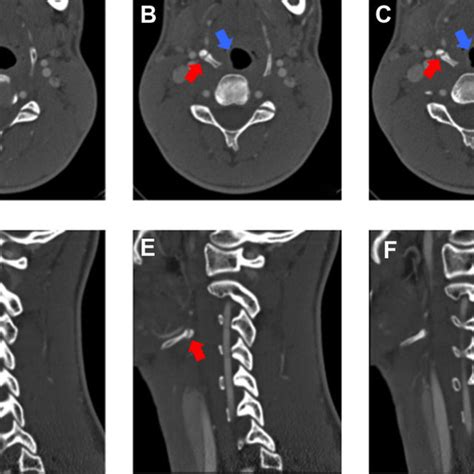 A C Noncontrast Computed Tomography Scans Axial Views Of Cervical
