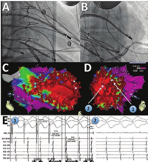 Catheter Ablation Of Ventricular Tachycardia Using A Robotic Download