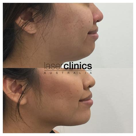 Dermal Fillers Aura Laser Derma And Esthetic Clinics
