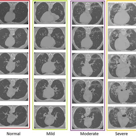 Classification Process For Computed Tomography Ct Images To Normal