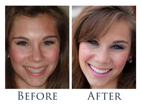 Before And After Orthodontics Gallery