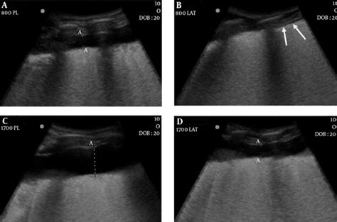 Depth Of Pleural Effusion In Thoracentesis Comparison Of Lateral