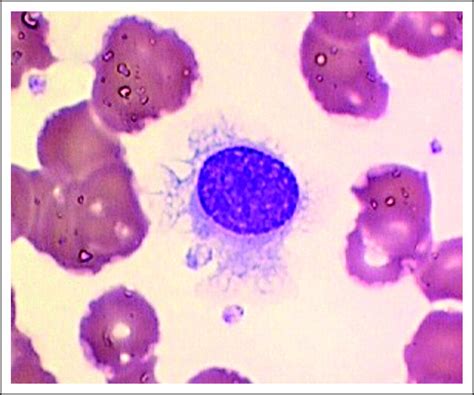 Hairy Cell Leukemia Cladribine Leukemia Hematology Leukemia Awareness