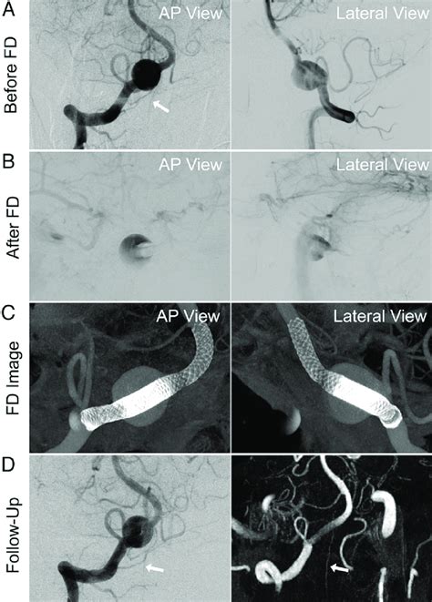 A 14 Mm Fusiform Saccular Right Va Aneurysm Treated By Fd A
