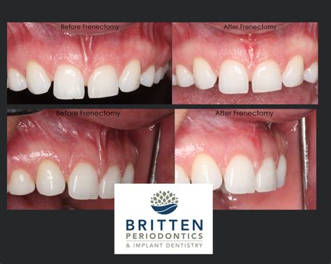 Labial Frenectomy Before And After