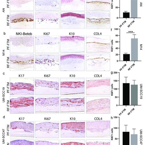 Effect Of Fibroblast Subpopulations On Melanoma And Hnscc Download