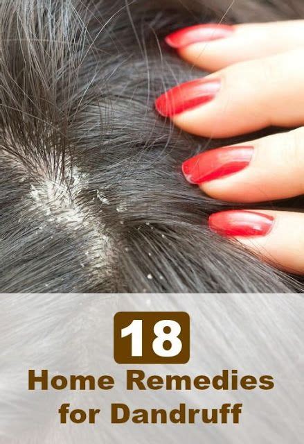how to know if you have dandruff