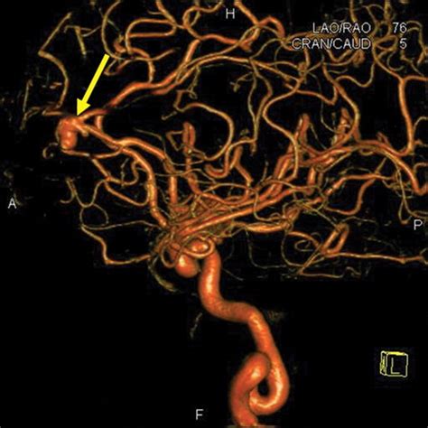 Digital Subtraction Ct Angiography For Detection Of Intracranial