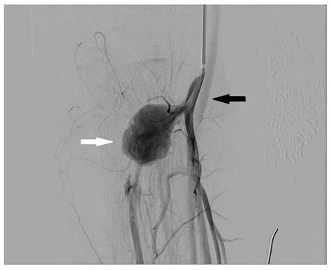 Radiation Free Full Text Digital Subtraction Angiography Dsa
