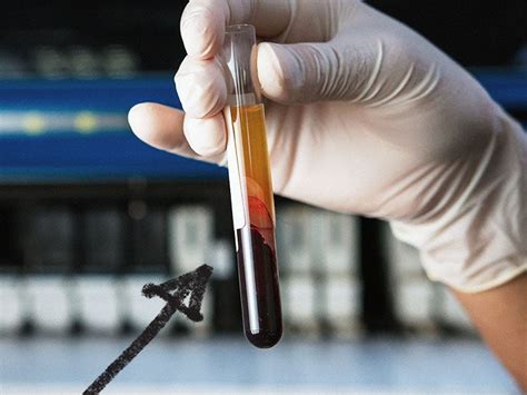 C Peptide Test Ranges And Purpose