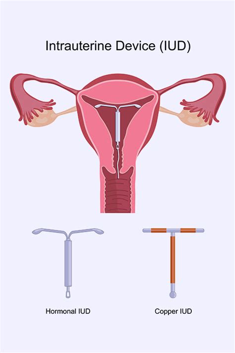 Intrauterine Device Iud Types Side Effects Success Procedure And More