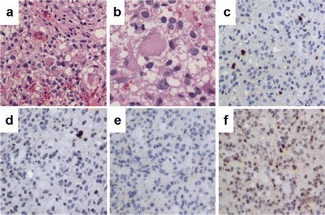 Pathological Micrographs From The Surgical Specimen Obtained At The