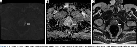 Table 1 From Evaluation Of Multiparametric Prostate Magnetic Resonance