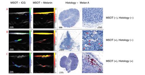 Sentinel Lymph Node Sln Visualization Using A Handheld Multispectral