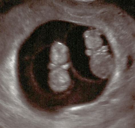 Monochorionic Dizygotic Twins Conceived Spontaneously Showed Chimerism