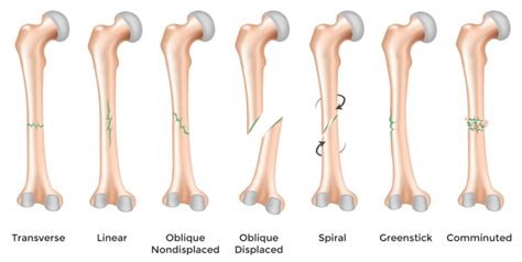 Fractures – Symptoms Causes And Other Risk Factors
