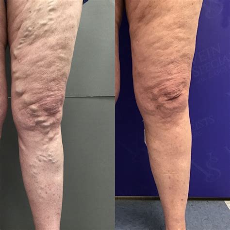 Before And After Vein Treatment Photos Vein Specialists Of The Carolinas