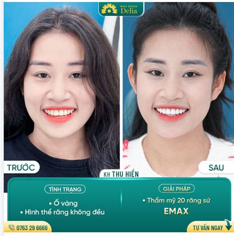 Khách Hàng Thu Hiền Khắc Phục Mọi Nhược điểm Răng Khấp Khểnh Ố Vàng