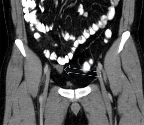 Undescended Testis Image