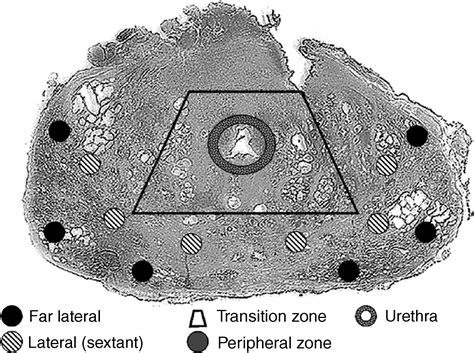 Sensitivity And Detection Rate Of A 12 Core Trans Perineal Prostate