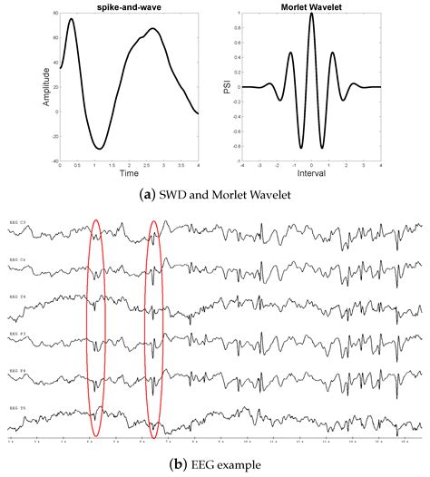 Statistical Model Based Classification To Detect Patient Specific Spike