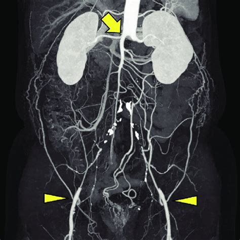 Abdominal Contrast Enhanced Computed Tomography Showed Complete