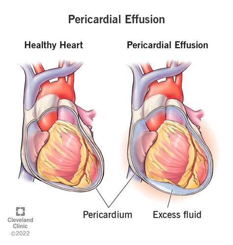 Pericardial Effusion Symptoms And Causes