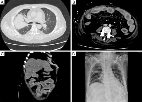 Computed Tomography Ct Imaging Of The Patient A Chest Computed