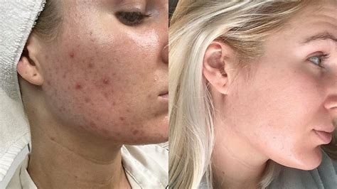 How I Cleared My Acne My Skincare Routine Youtube