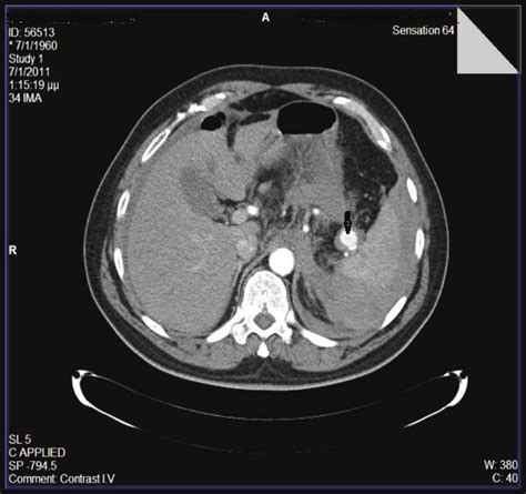 2 Perihepatic And Perisplenic Hemorrhage Secondary To A Ruptured
