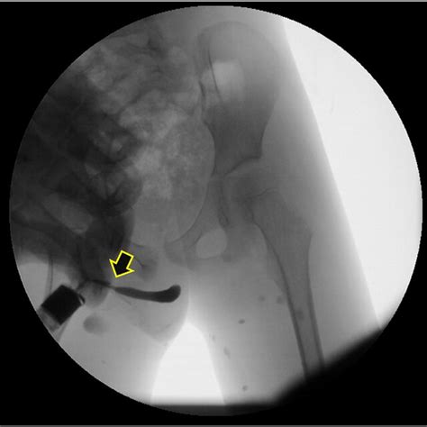 A Retrograde Urethrogram Showing A Penile Urethral Stricture Arrow